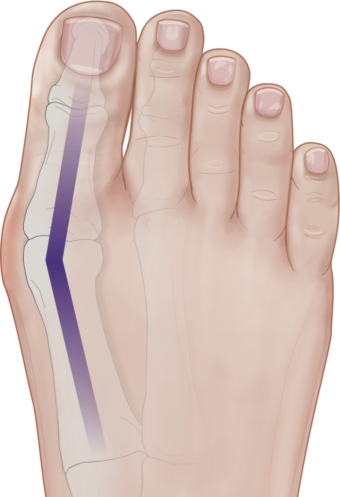 About Bunions - Bunion Relief