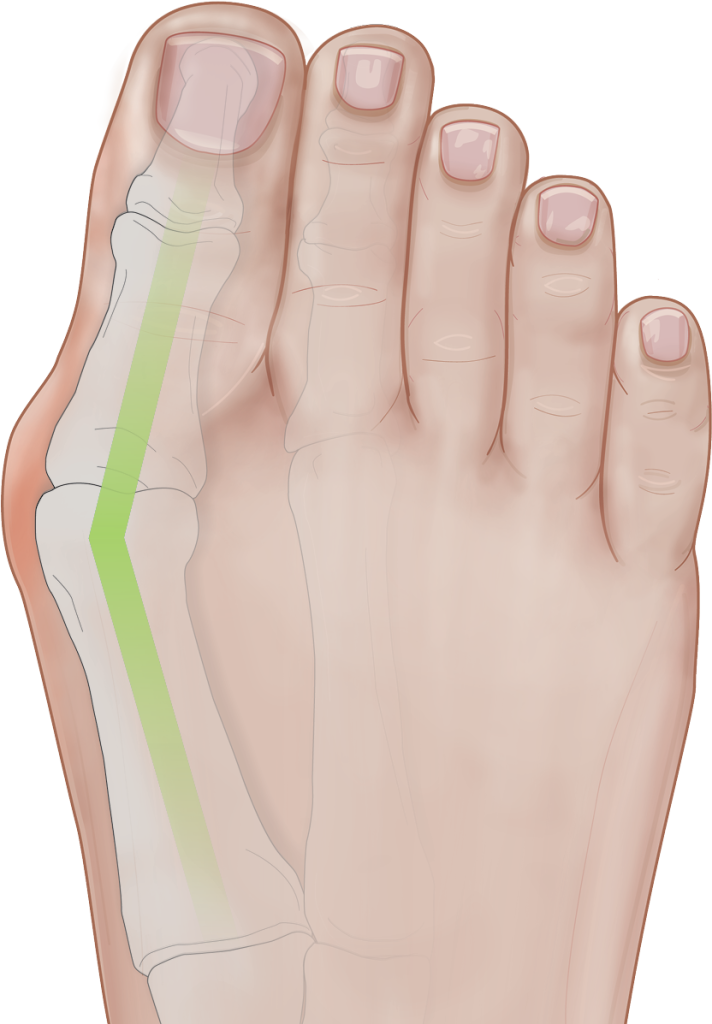 About Bunions - Bunion Relief