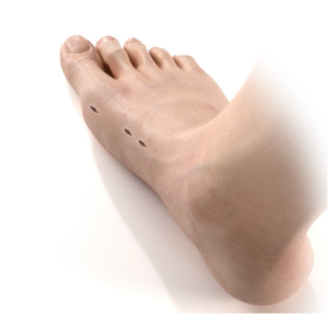 Precision® MIS - Bunion Relief